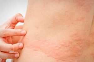 Anda Biduran? Bentol-bentol dan Gatal Karena Alergi Dingin? Begini Cara ...